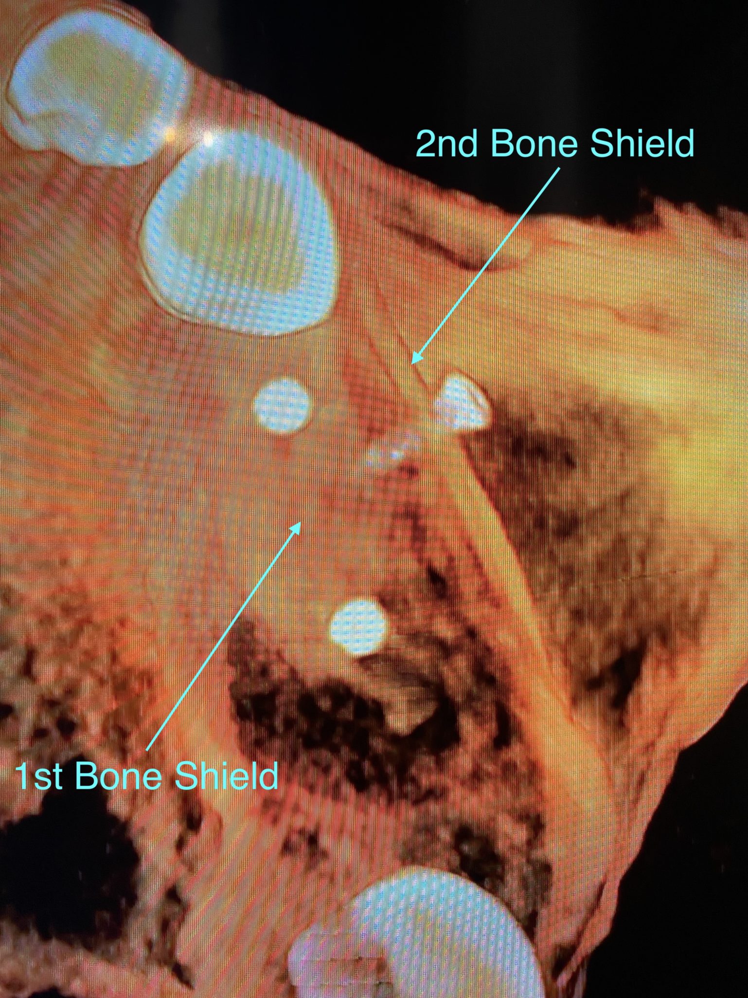 Bone Block Graft Harvested from Lower Jaw to Upper Left Quadrant Case ...